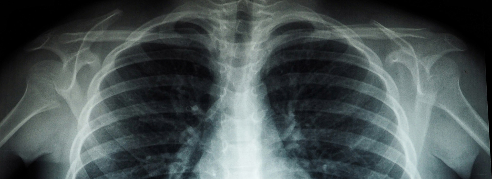Fundamentals of Radiographic Image Interpretation: Chest CPD Course ...